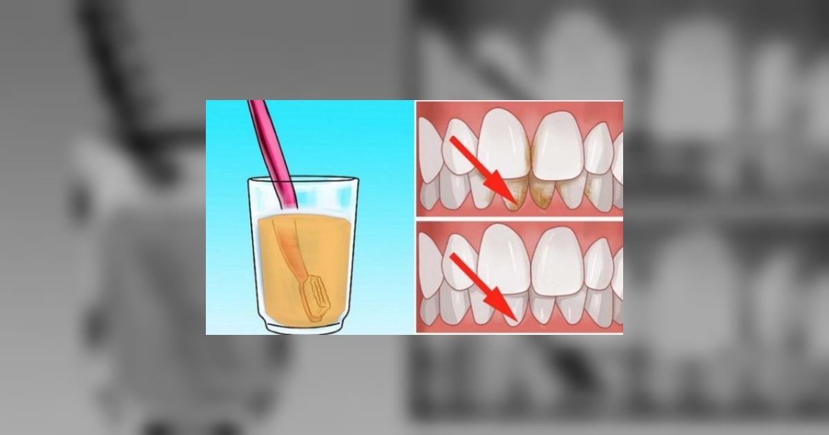 Medicul dentist nu ti-ar spune niciodata acest SECRET! Iata cum scapi ...