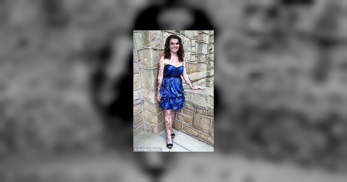 Aceasta fetita are o boala rara de piele care o face sa arate unic in ...